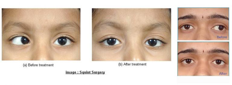වපරය - Are you suffering from squint